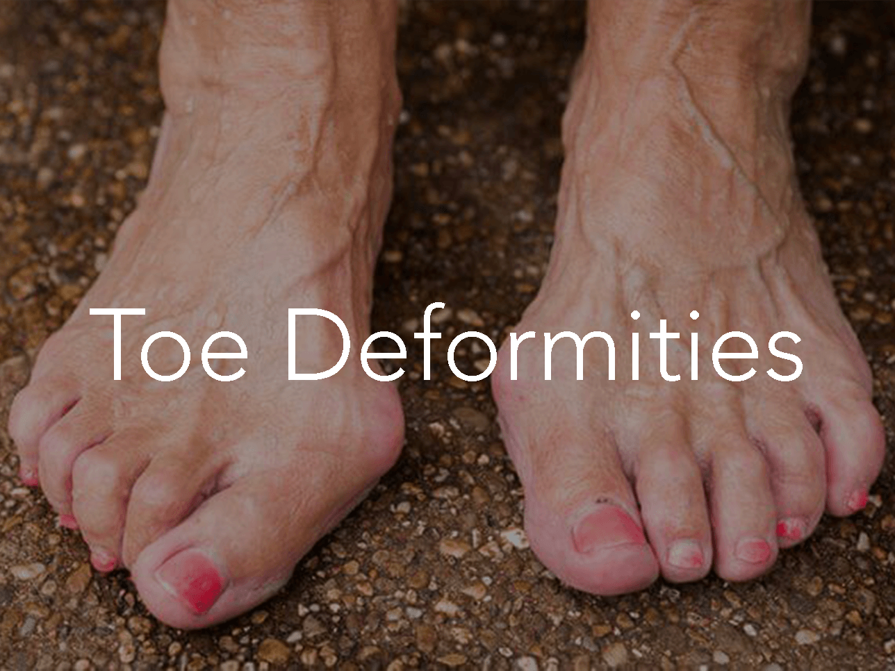 Toe Deformities Treatment in Mathura - Dr Swapnil Verman